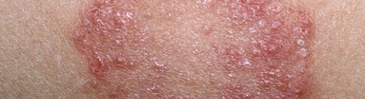 CDC warns of "alarming" rise of potentially deadly fungal threat in ...